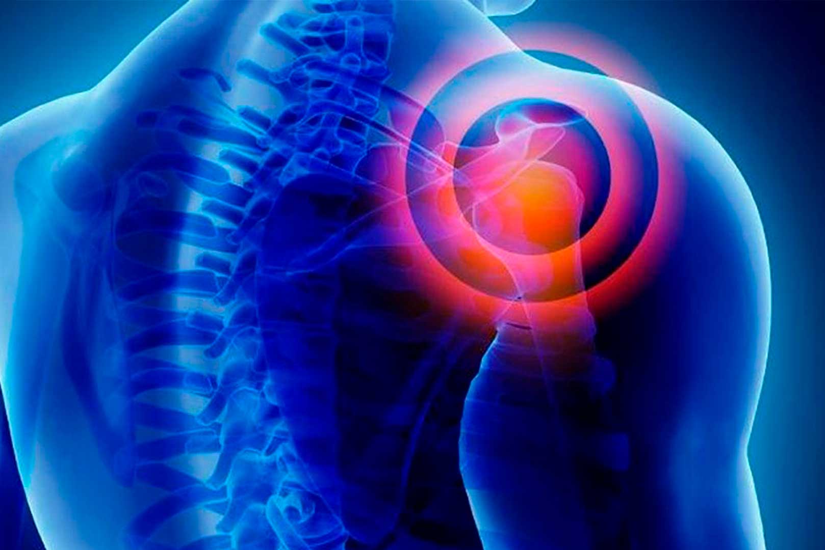 Tendinitis y Bursitis de Hombro 2025 | Diagnóstico y tratamiento con ...